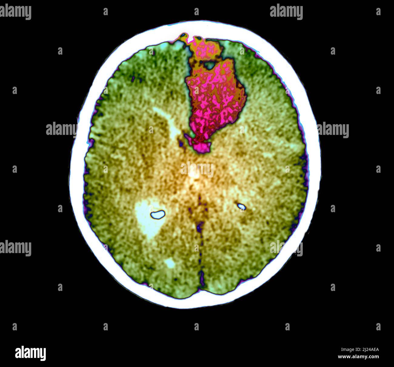 Brain haemorrhage, CT scan Stock Photo - Alamy