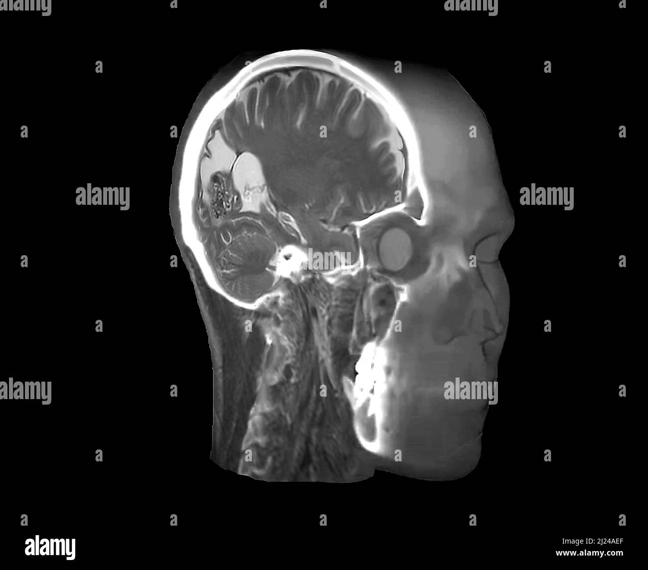 Arteriovenous malformation, composite MRI and 3D CT scan Stock Photo ...