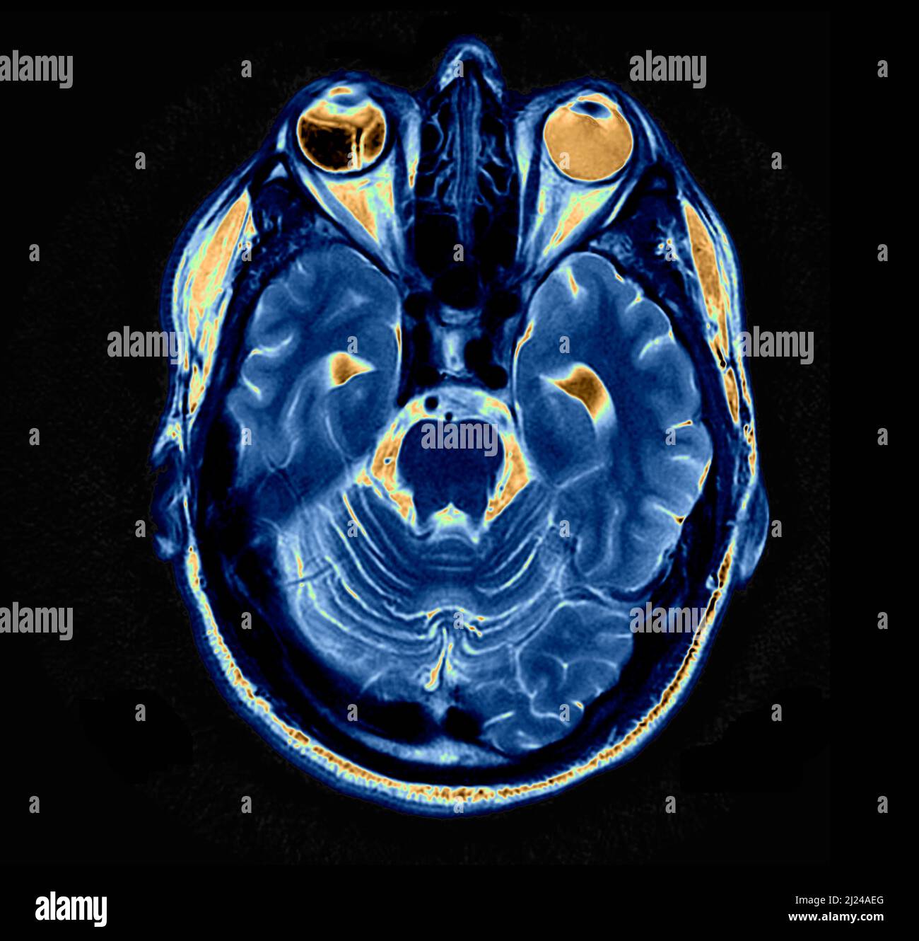 Retinal detachment, MRI scan Stock Photo - Alamy