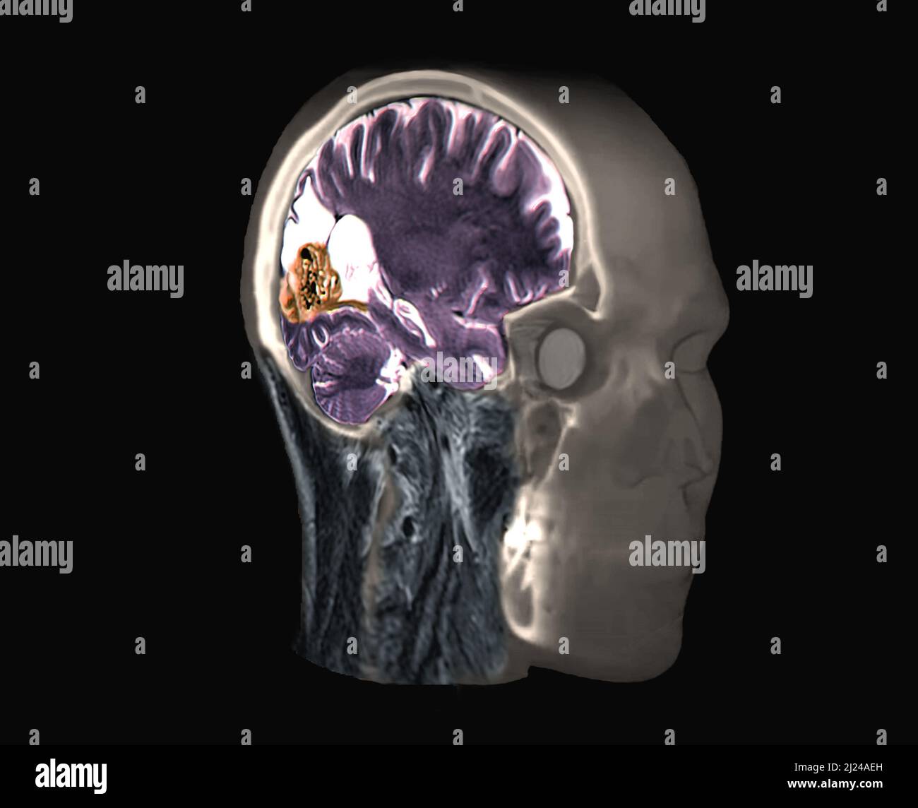 Arteriovenous malformation, composite MRI and 3D CT scan Stock Photo ...