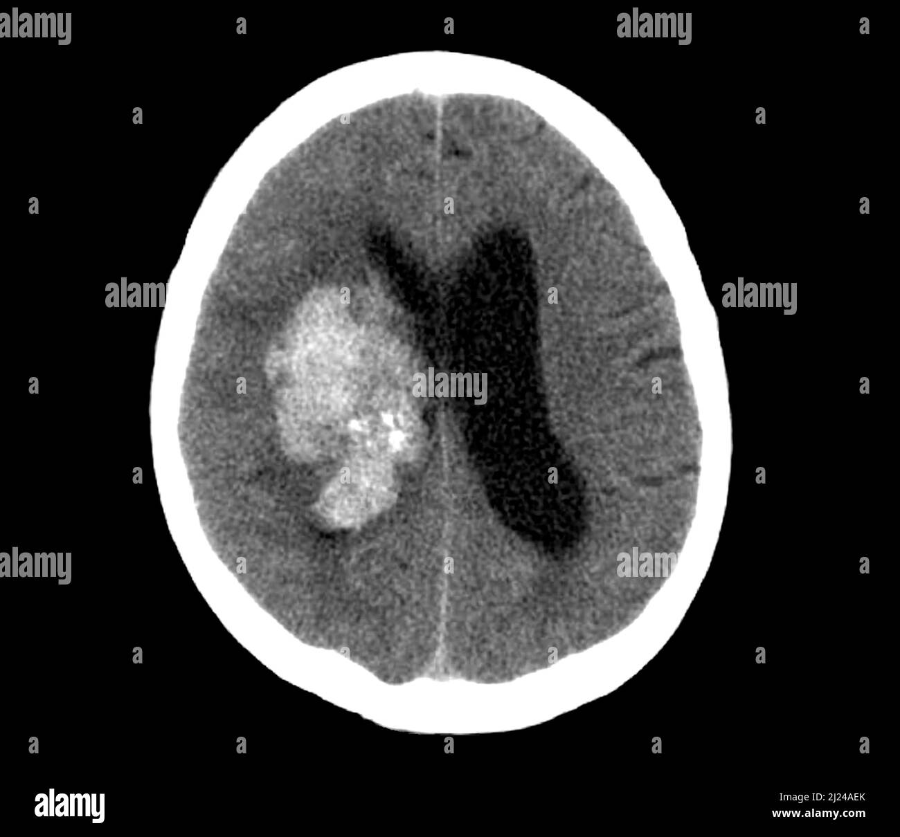 Cerebral haemorrhage, CT scan Stock Photo - Alamy