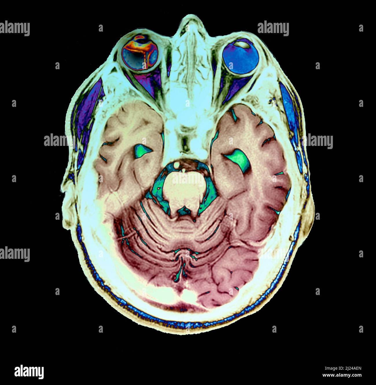 Retinal detachment, MRI scan Stock Photo - Alamy