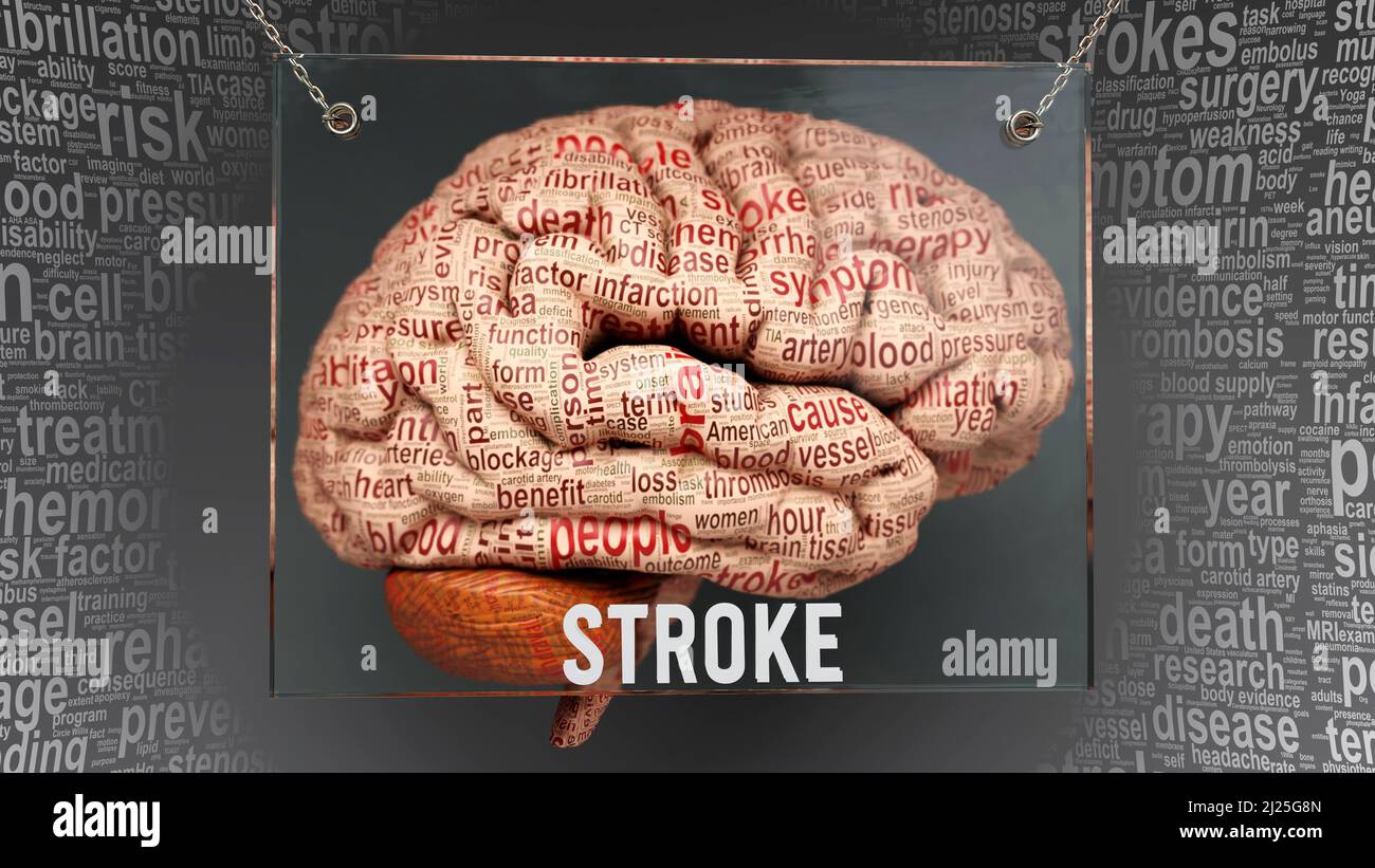 Stroke anatomy - its causes and effects projected on a human brain ...