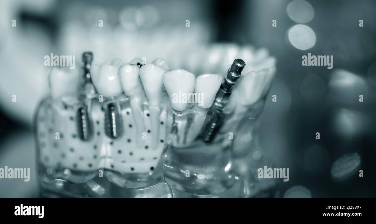 Transparent Model of Human Teeth with implants close-up Stock Photo - Alamy