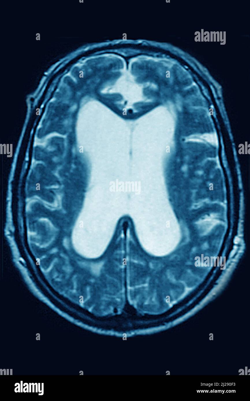 Hydrocephalus brain hi-res stock photography and images - Alamy