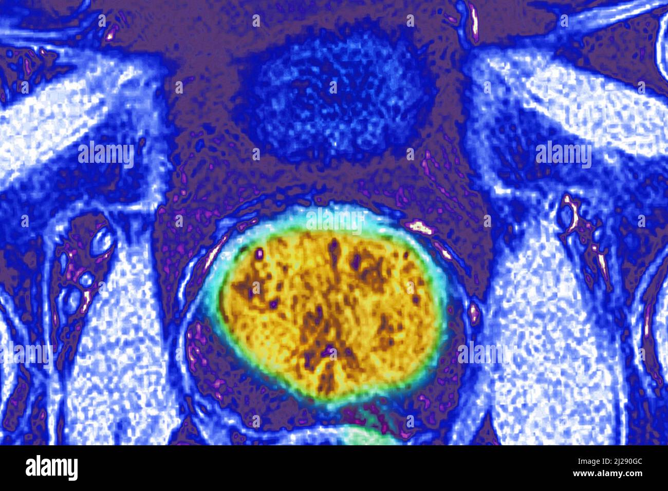 Benign prostatic hypertrophy Stock Photo - Alamy