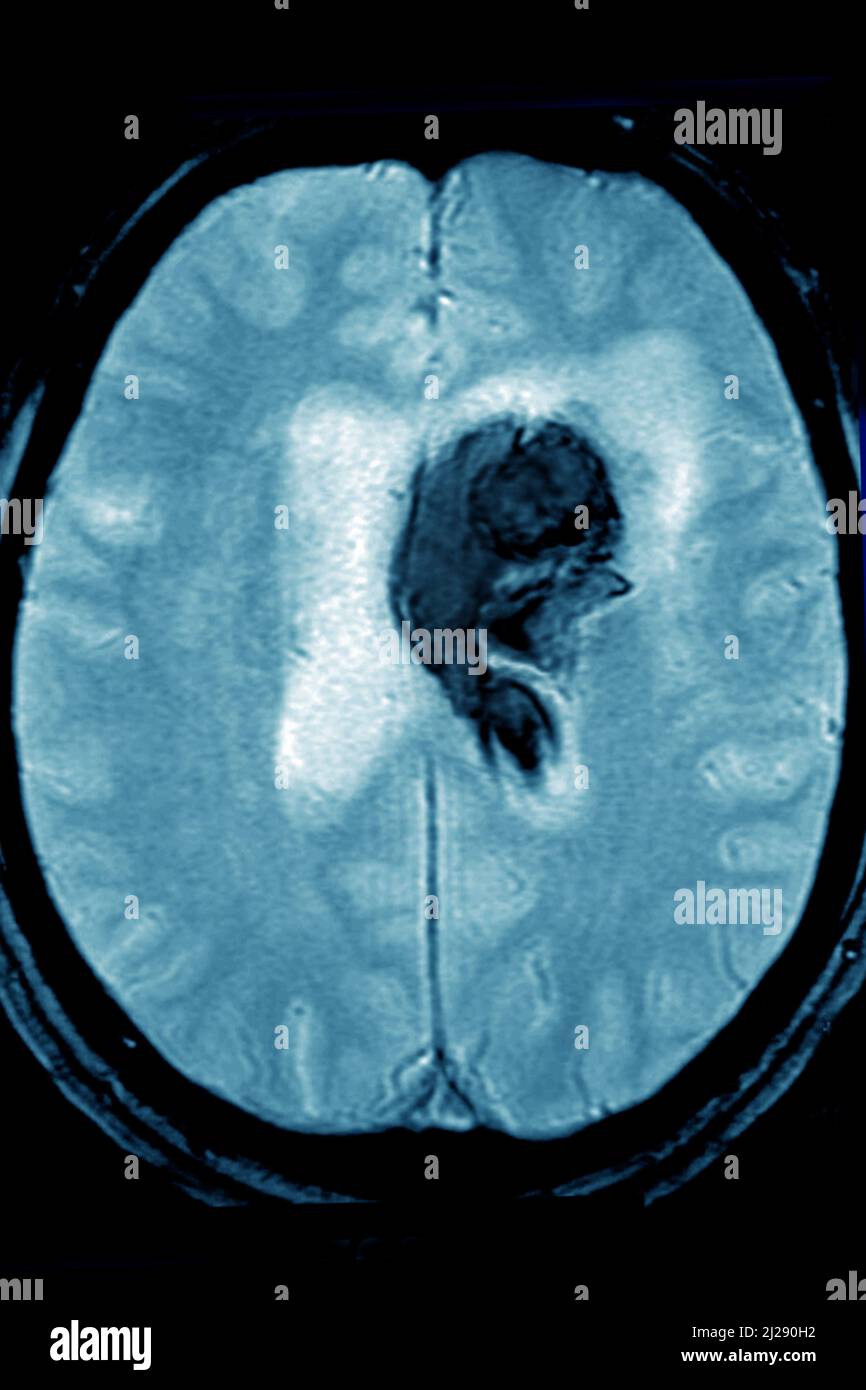 Cerebral vascular accidents hi-res stock photography and images - Alamy