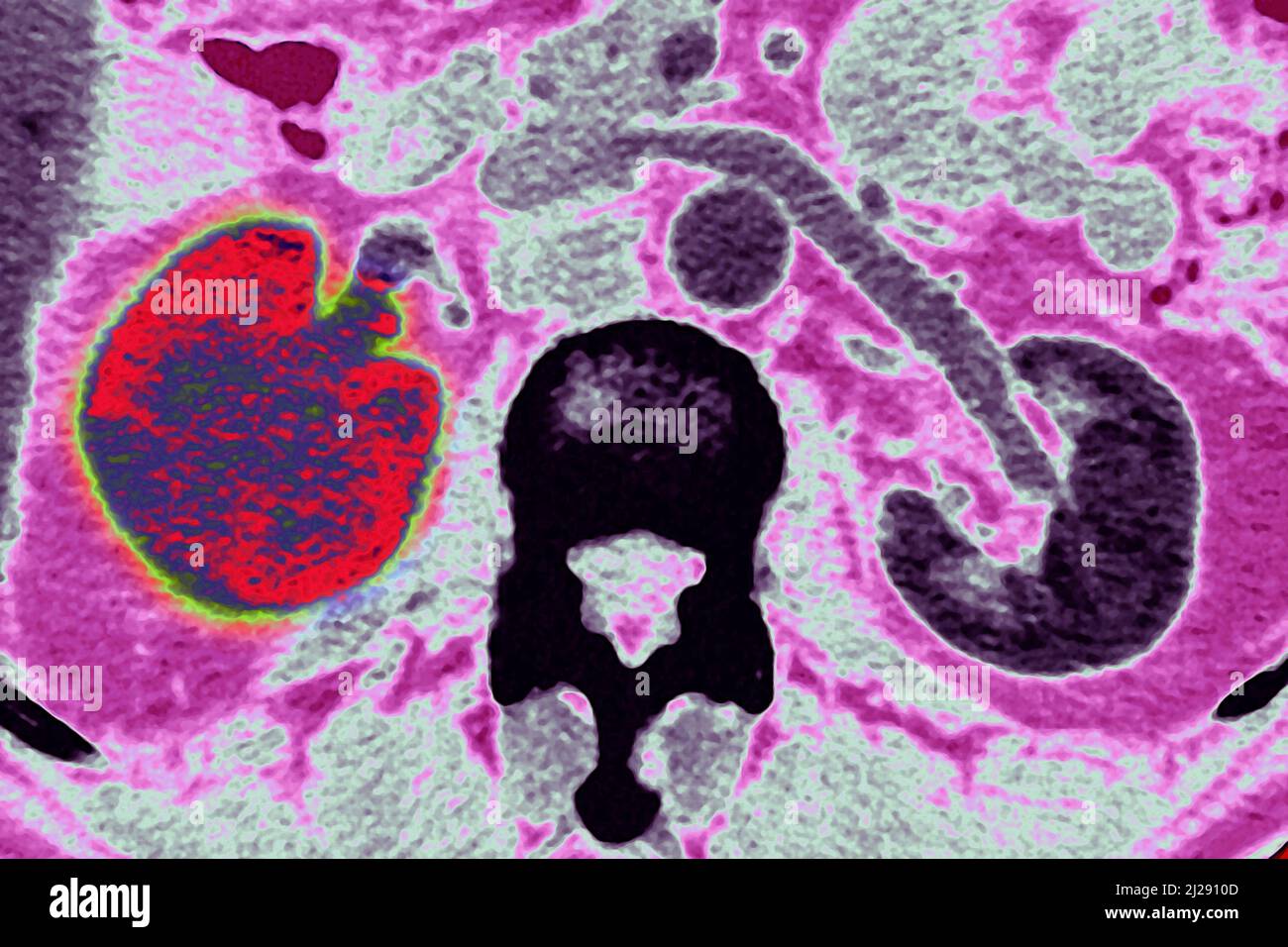 Kidneys ct scan hi-res stock photography and images - Alamy