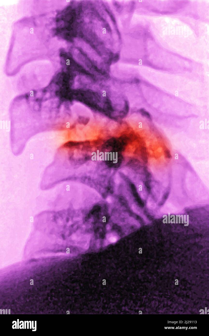 Dislocation of the cervical vertebrae Stock Photo - Alamy