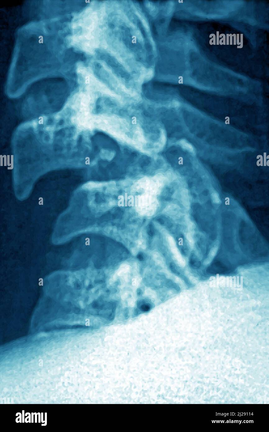 Dislocation of the cervical vertebrae Stock Photo - Alamy