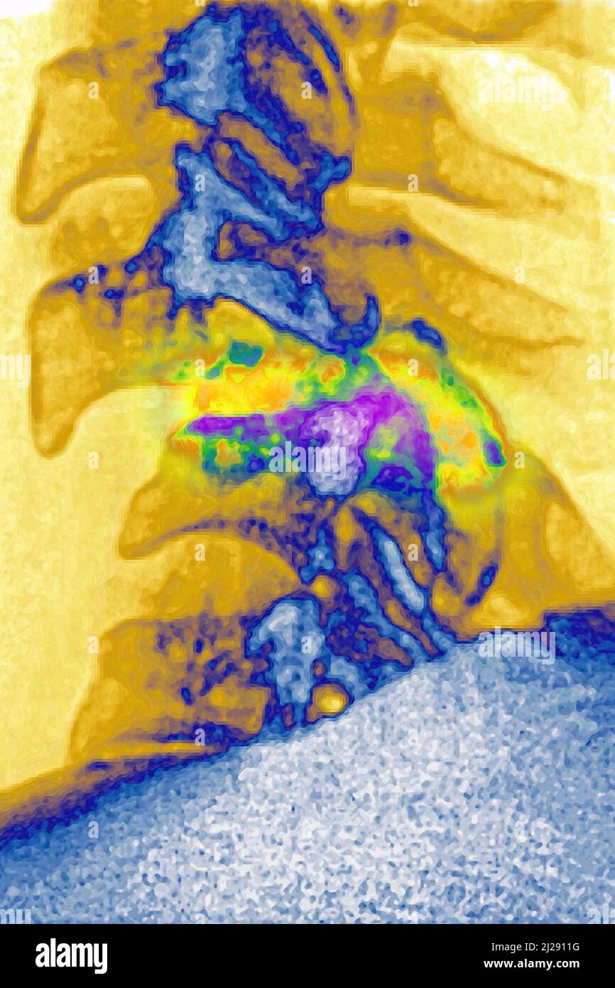 Dislocation of the cervical vertebrae Stock Photo - Alamy