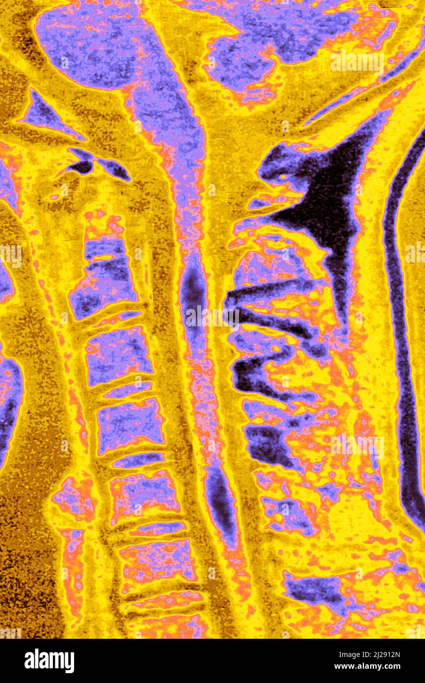 Spinal cord lesions hi-res stock photography and images - Alamy