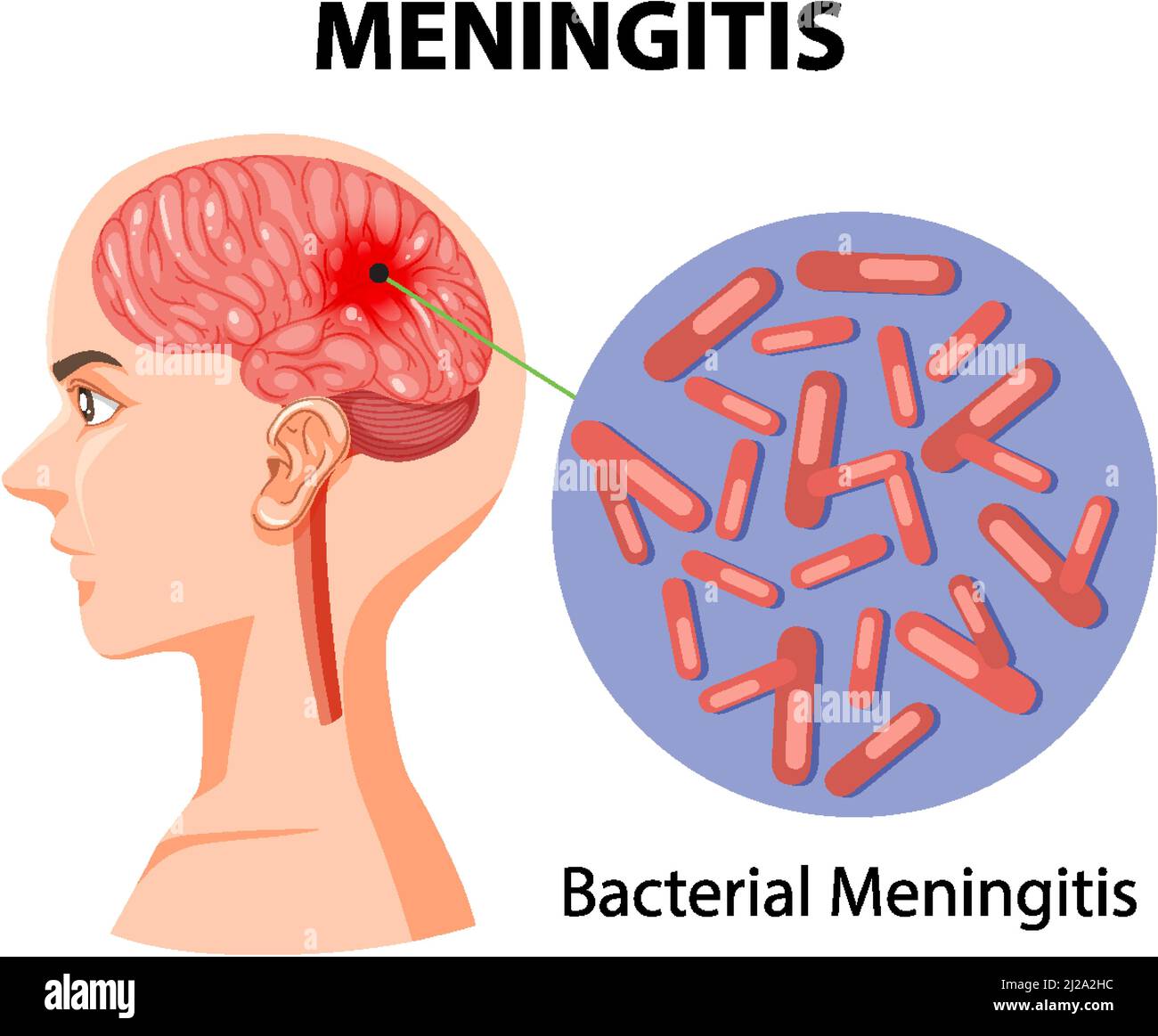 Diagram showing meningitis on human illustration Stock Vector Image ...