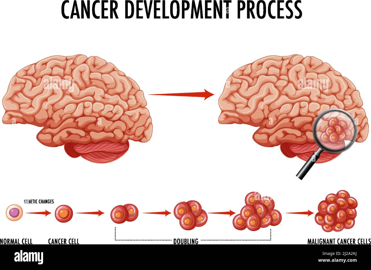 Diagram showing human brain and cancer illustration Stock Vector Image ...