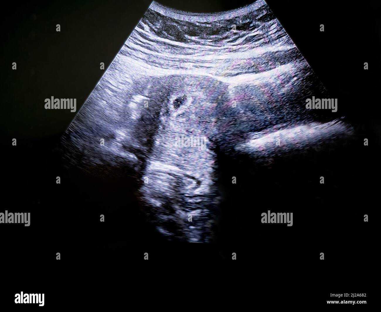 ultrasound of embryo at 5th weeks in pregnant woman Stock Photo - Alamy