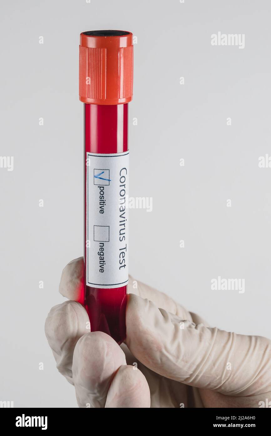 Vacuum tube with a blood sample with a positive result for Covid-19 ...