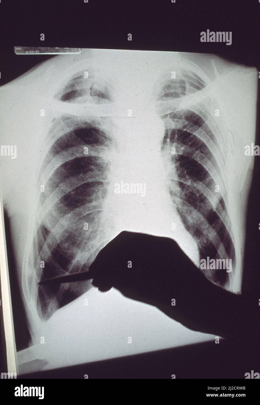 A lung damaged by emphysema is much larger than a normal lung ca. 1972 ...