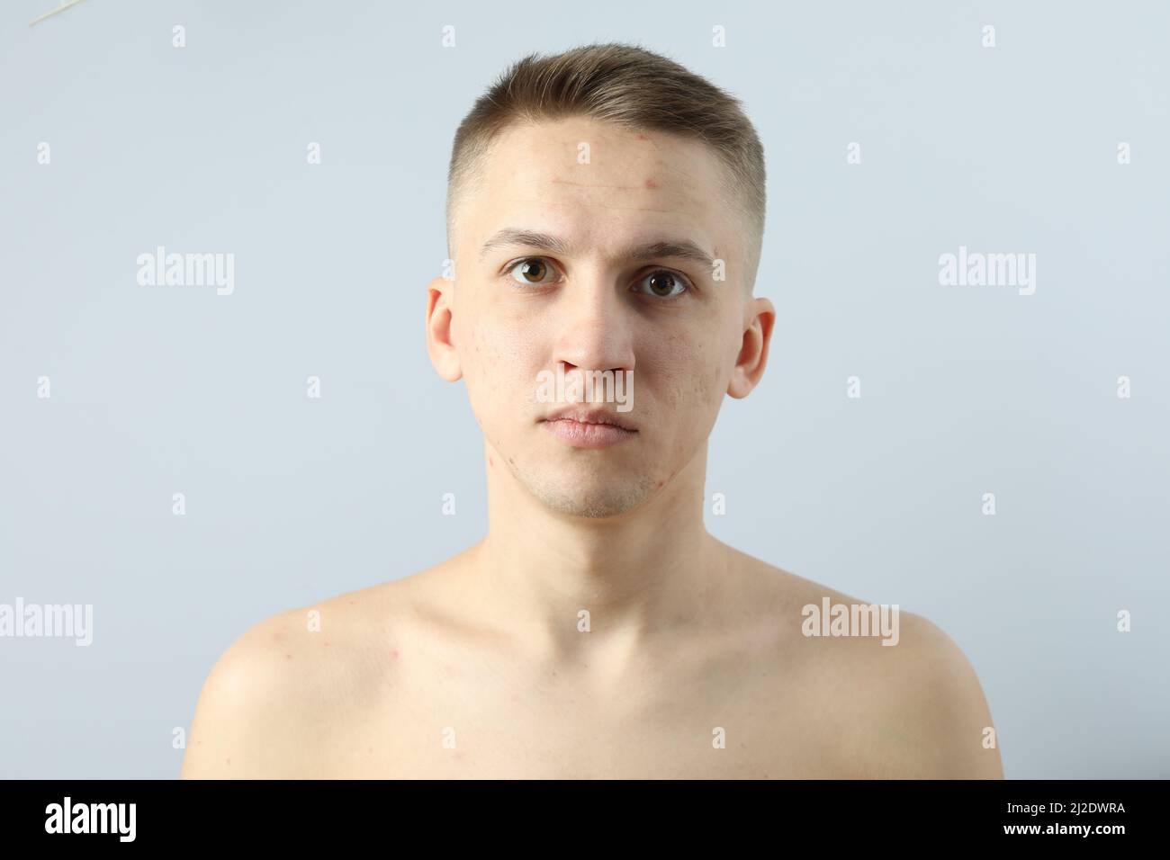 Skin cancer mole face woman hi-res stock photography and images - Alamy