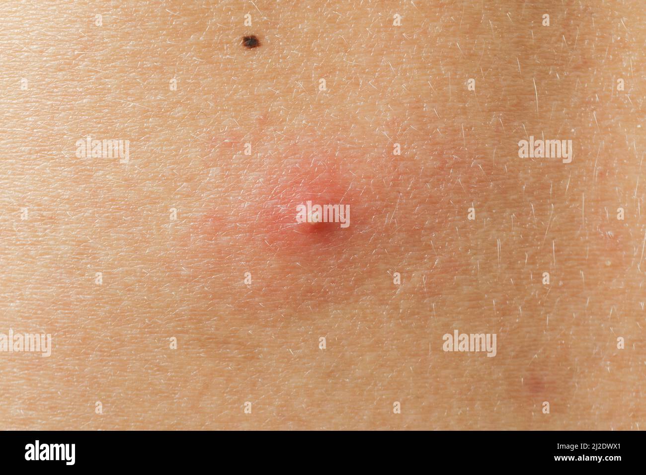 Concept of skin problems, acne, close up Stock Photo - Alamy