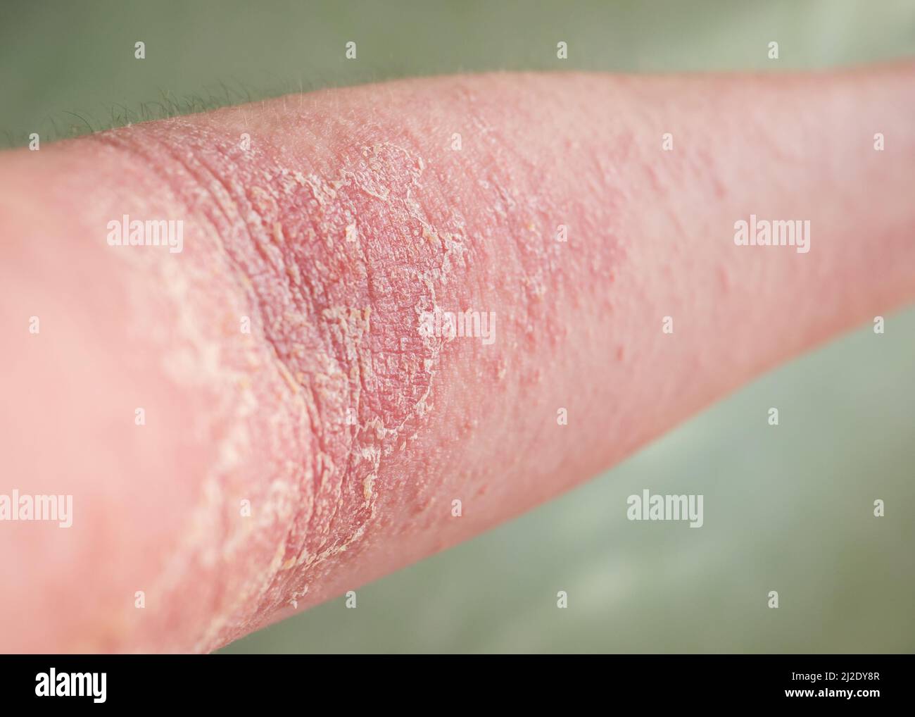 Eczema atopic dermatitis symptom skin hi-res stock photography and images - Alamy