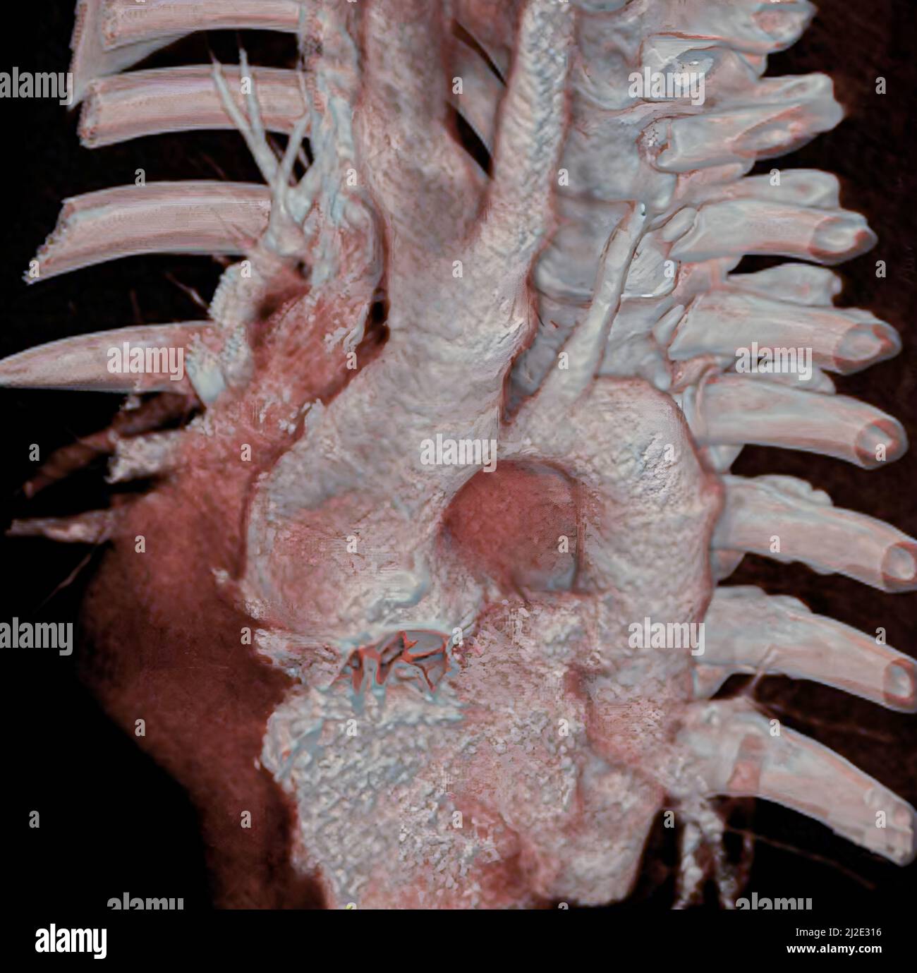 Coarctation of the aorta Stock Photo - Alamy