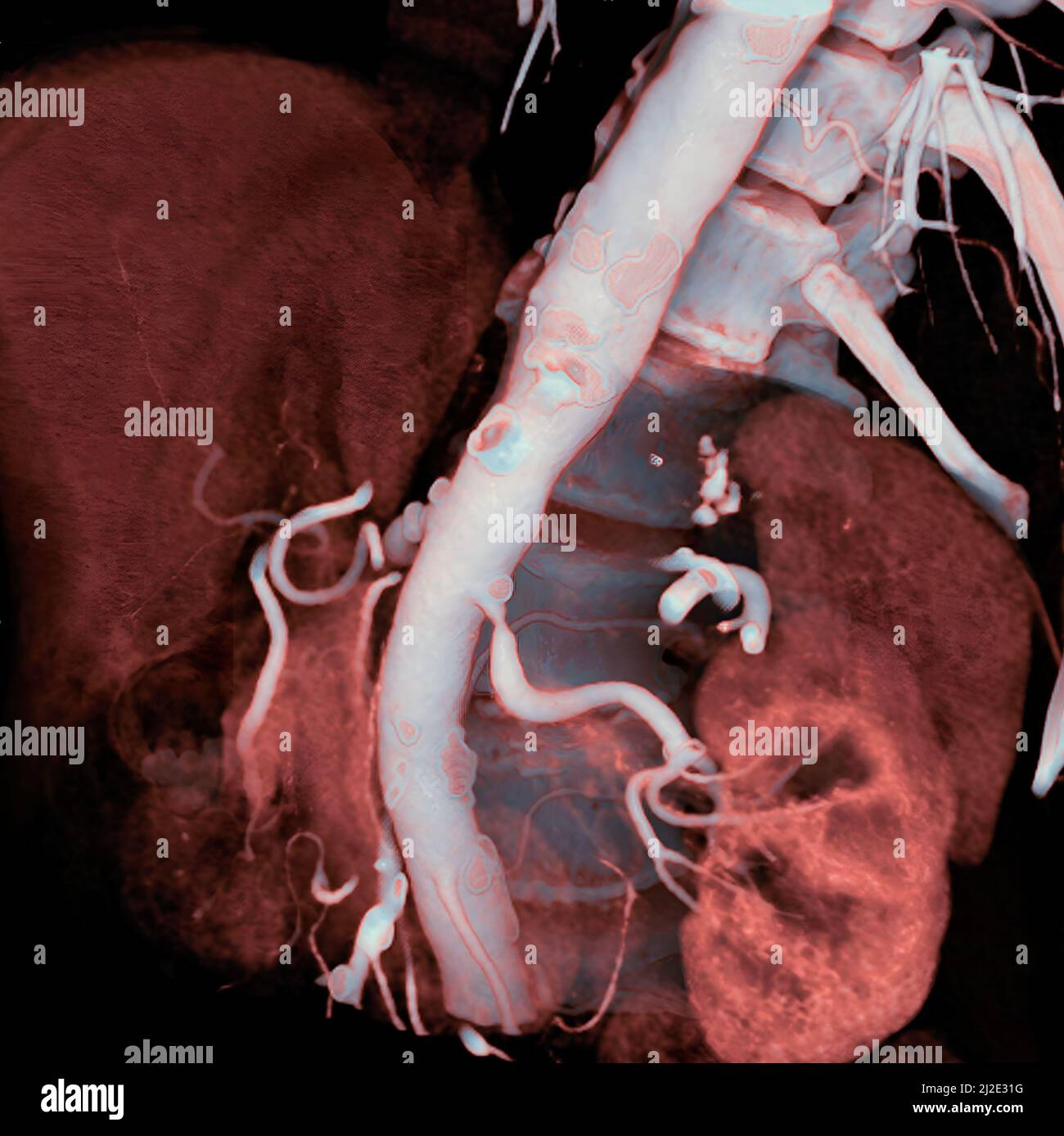 Aortic stenosis hi-res stock photography and images - Alamy