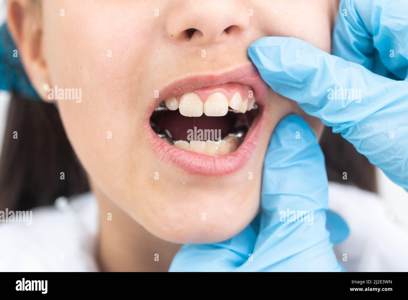 Girl putting on medical braces for orthodontic treatment over white ...