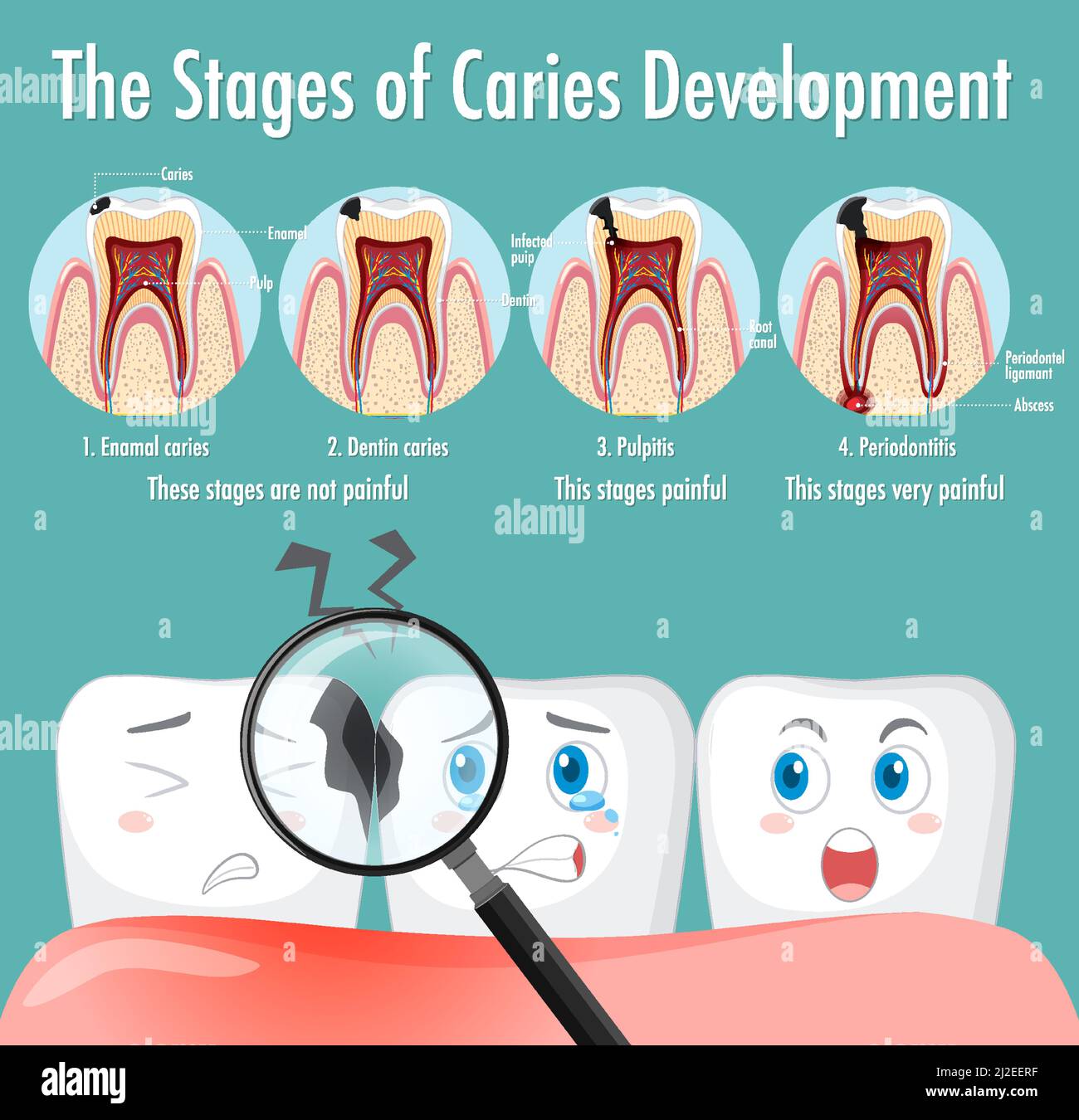 Infographic of human in stages of caries development illustration Stock ...