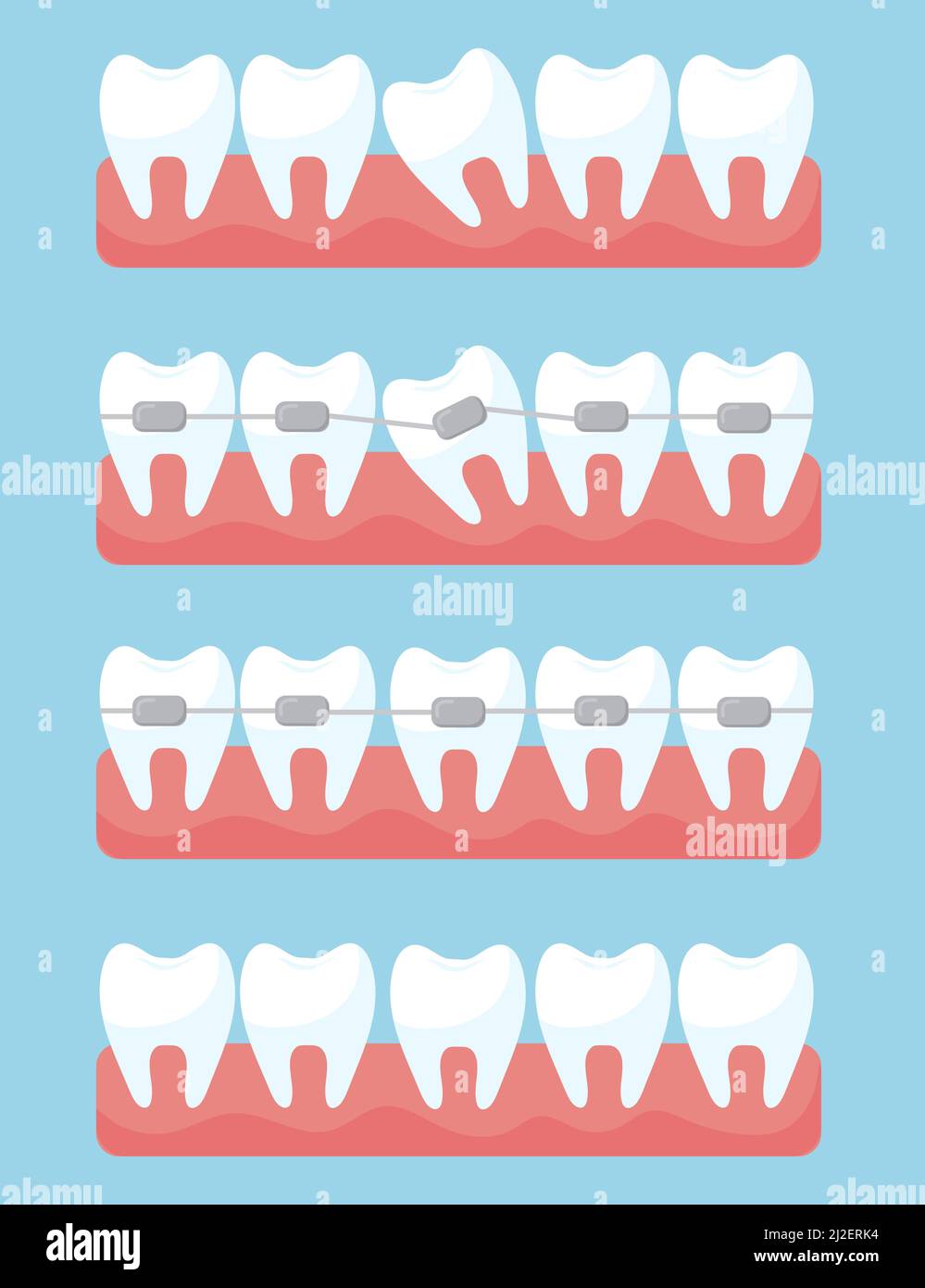 Orthodontic brackets Stock Vector Images - Alamy