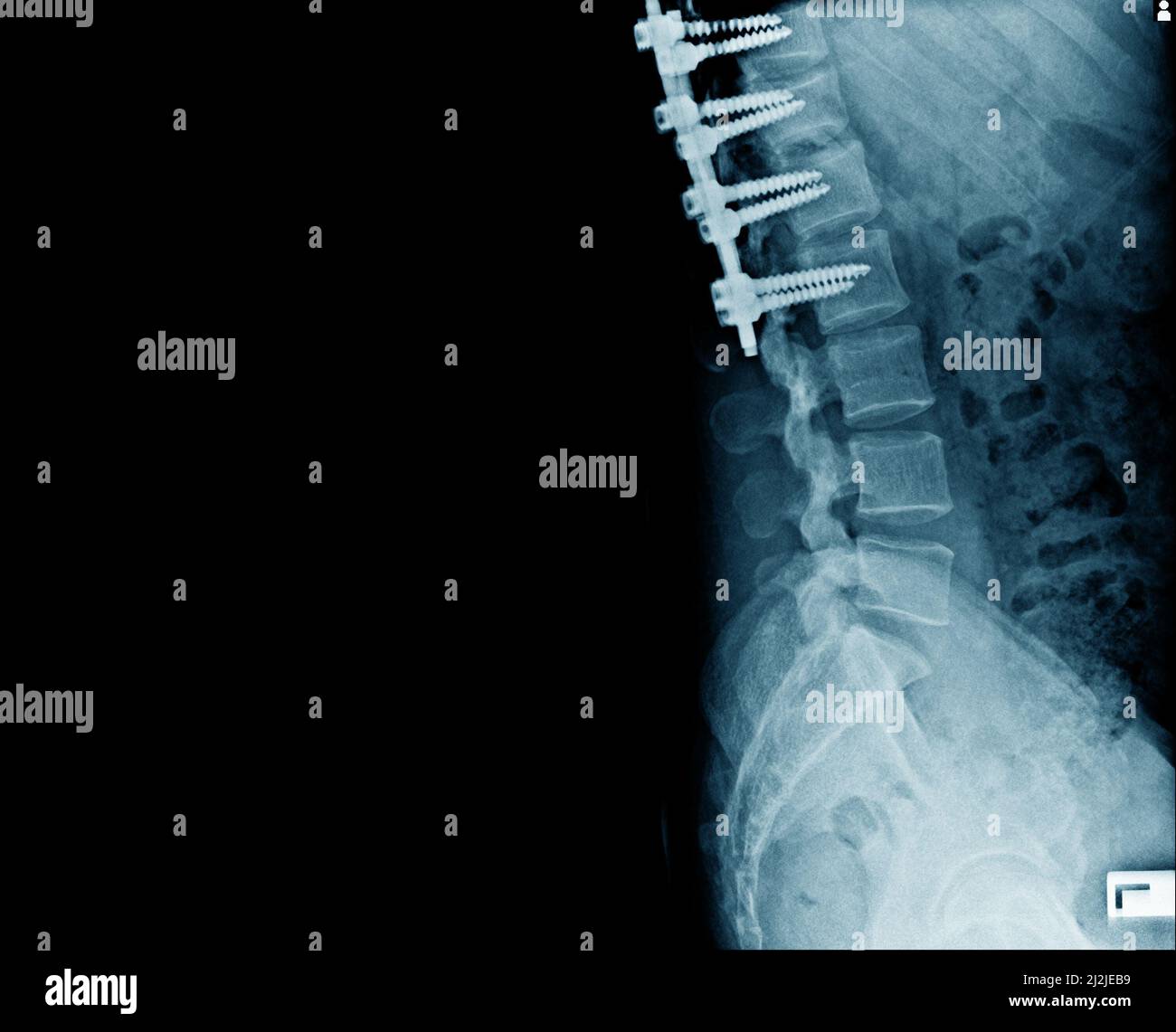 Lateral view of structure bone with internal fixation for prevent ...