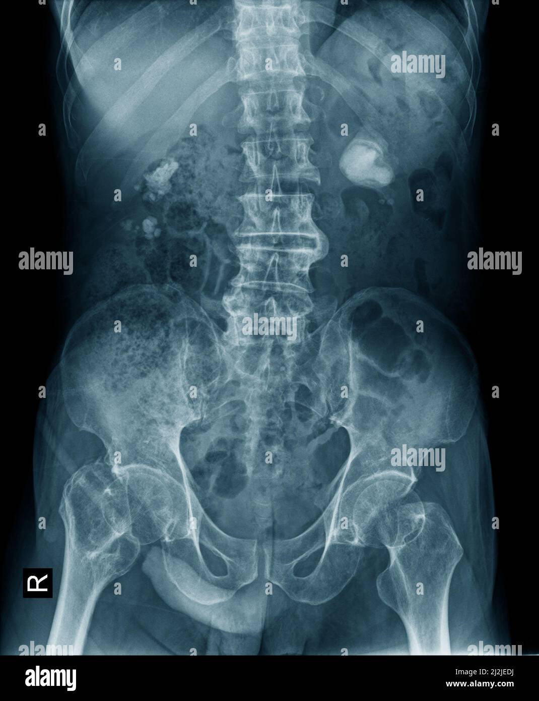 Renal calculus or kidney stone x-ray image in blue tone picture Stock ...