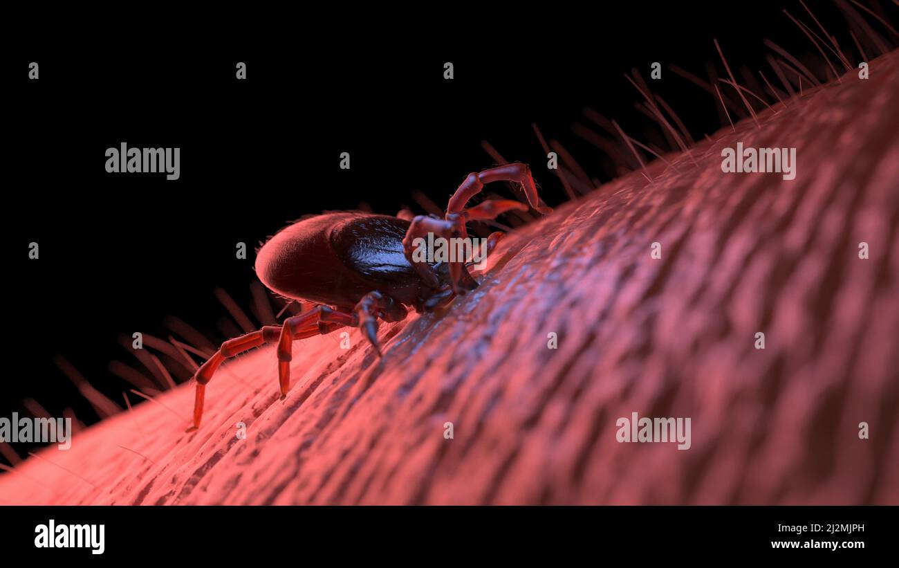 Tick biting human skin, illustration Stock Photo - Alamy