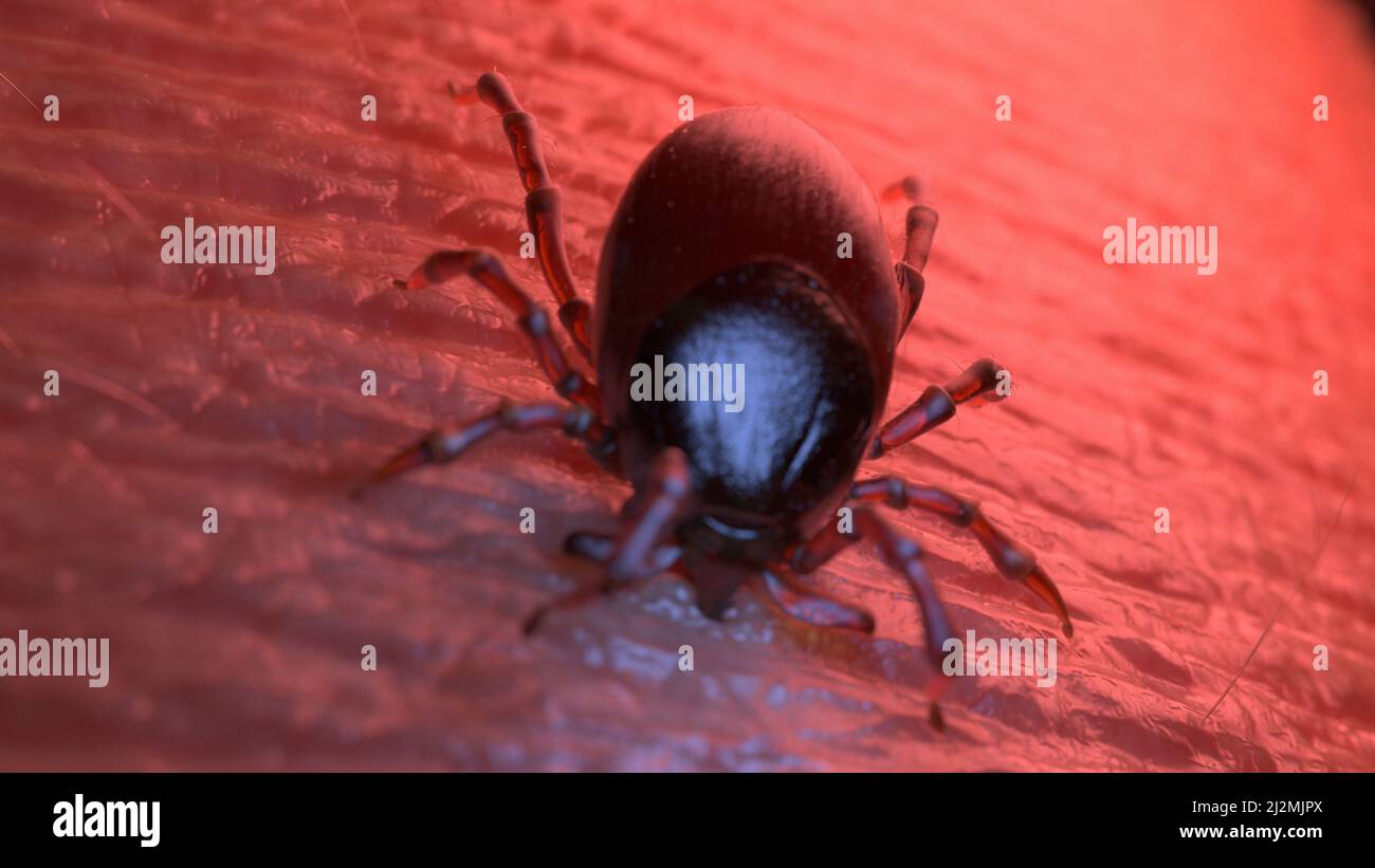 Tick biting human skin, illustration Stock Photo - Alamy