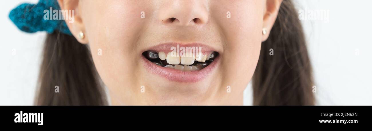 little girl with a plate on her teeth Stock Photo - Alamy