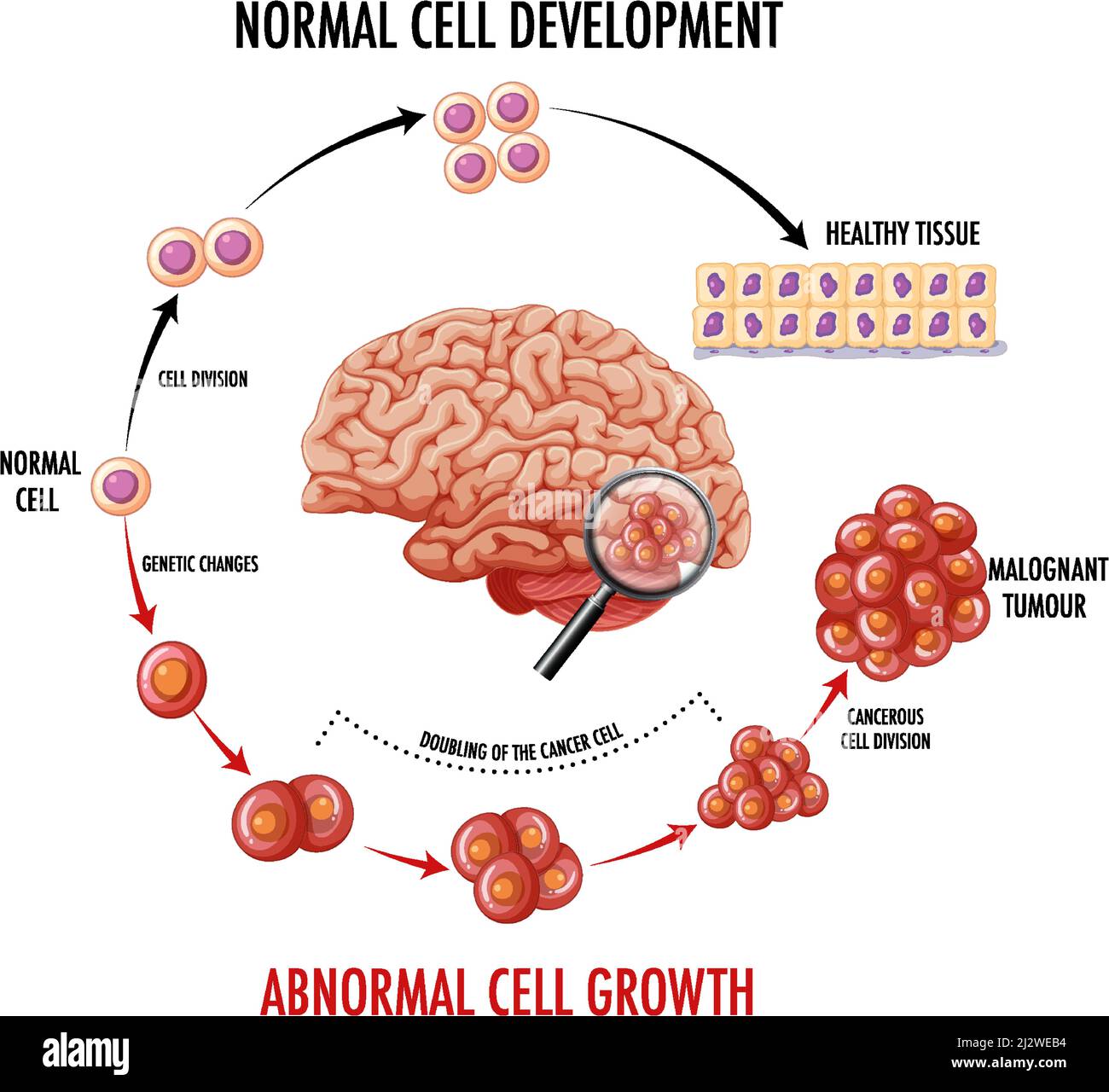 Brain Cancer Cells Diagram
