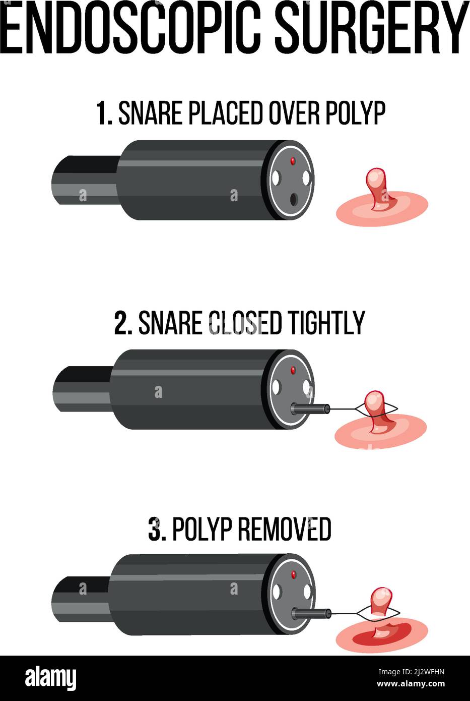 Diagram showing endoscopic surgery illustration Stock Vector Image ...