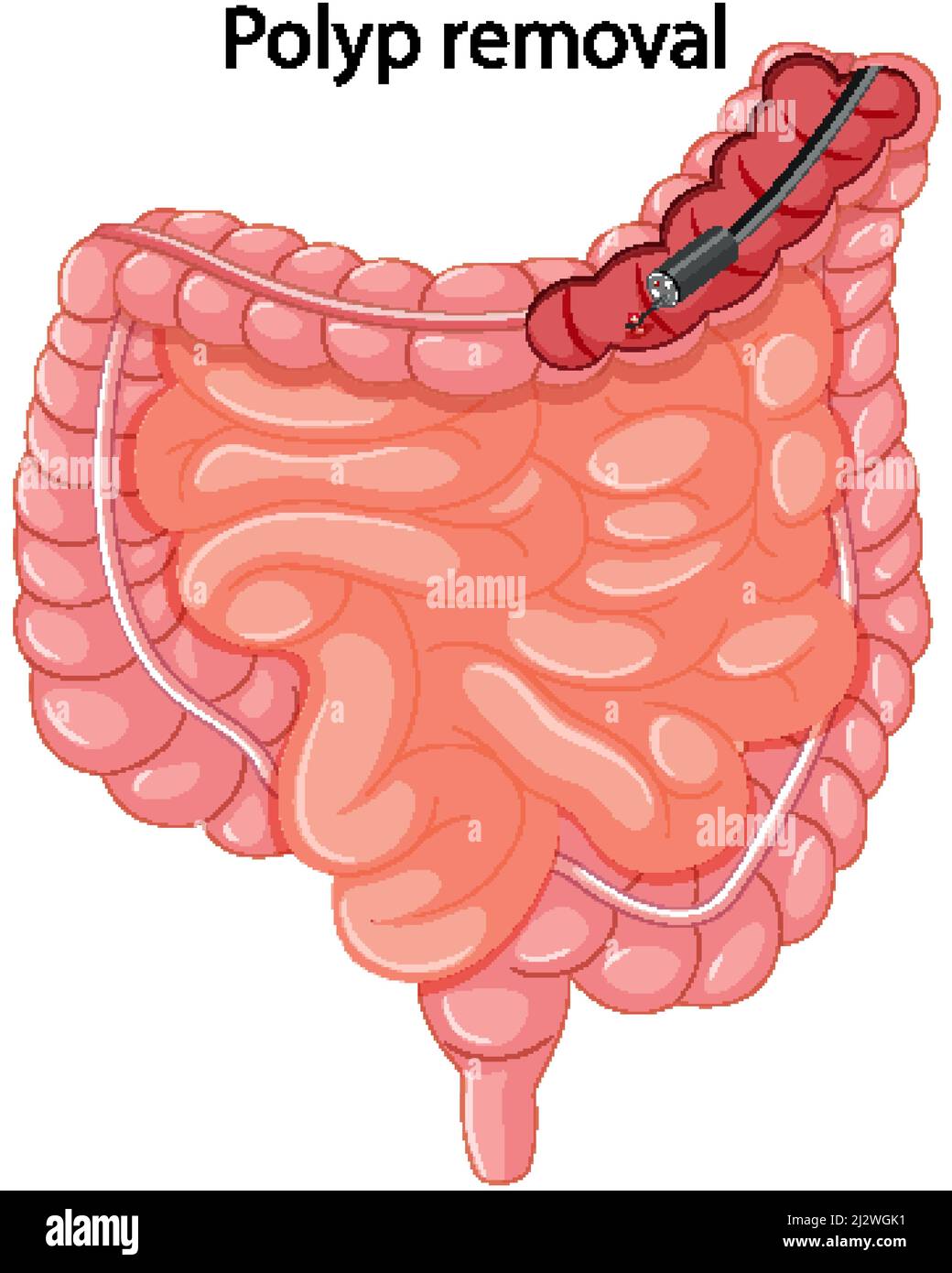 Polyp removal Stock Vector Images - Alamy