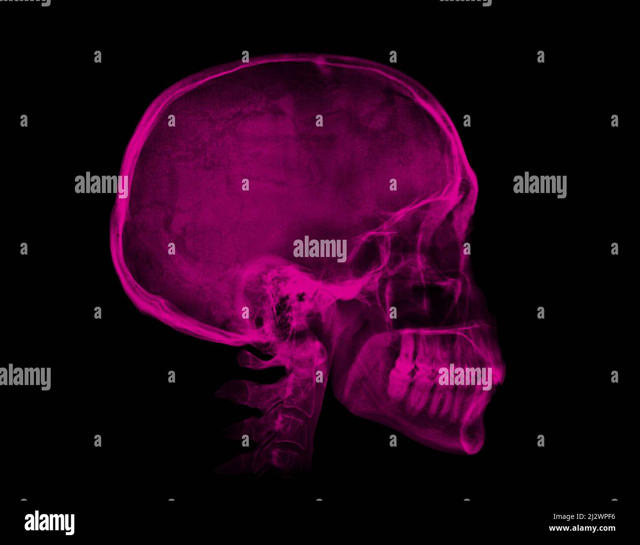 Human skull. Pink X-ray image isolated on black background Stock Photo ...