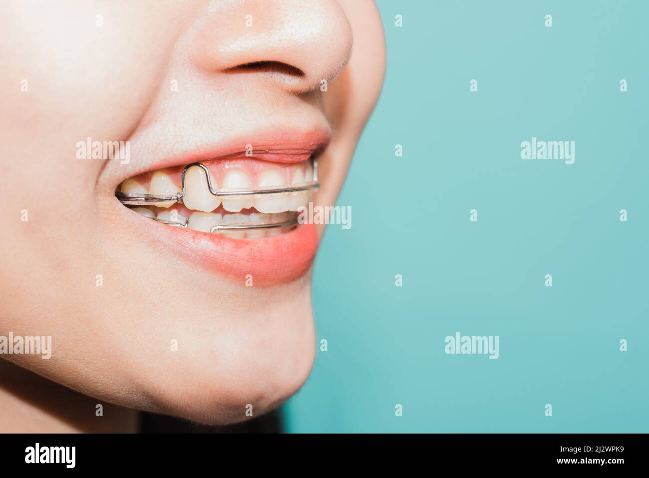 Close up white teeth of young Asian beautiful woman smiling wear ...