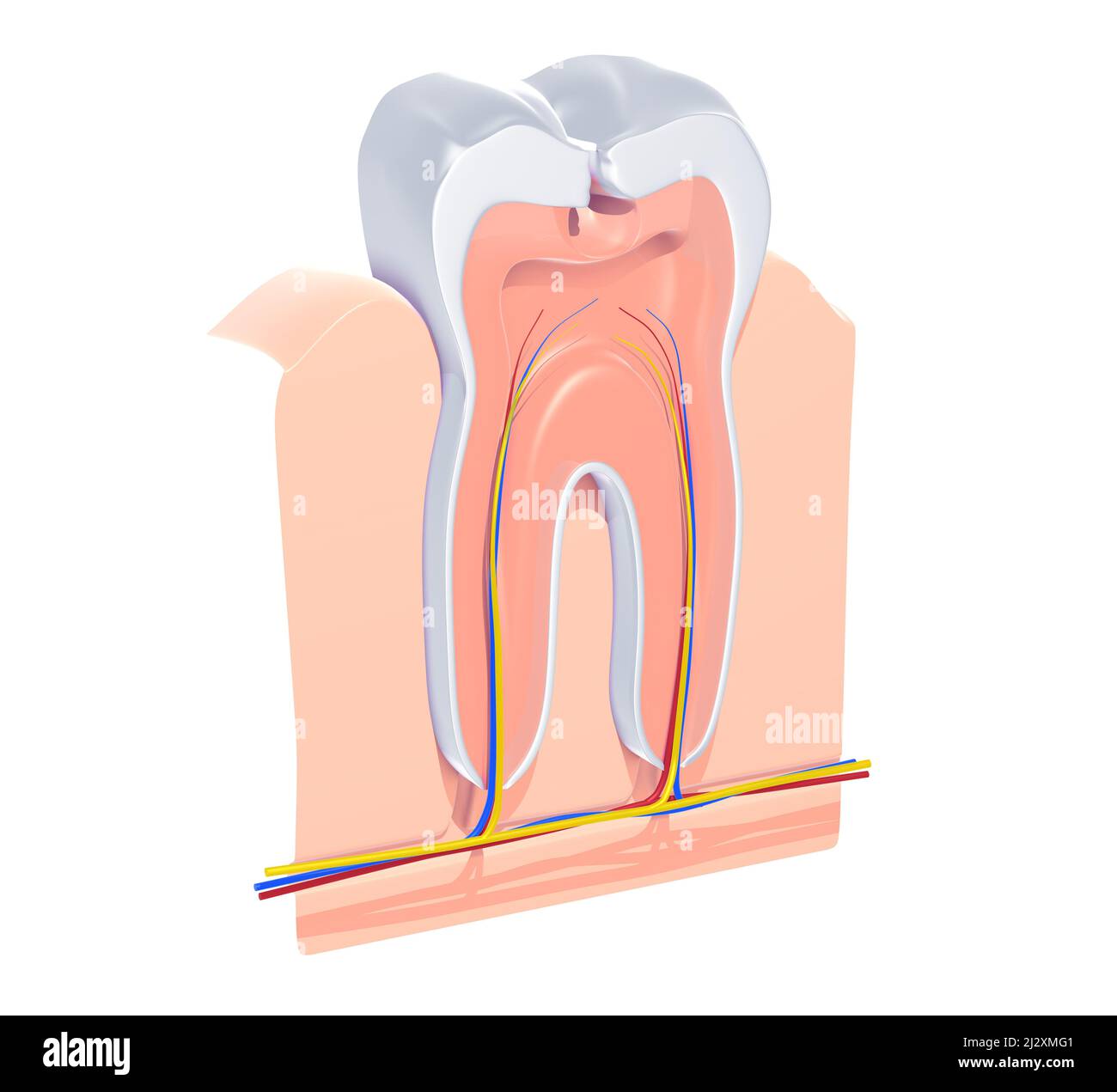 3d illustration of the anatomical view of a tooth damaged by caries ...