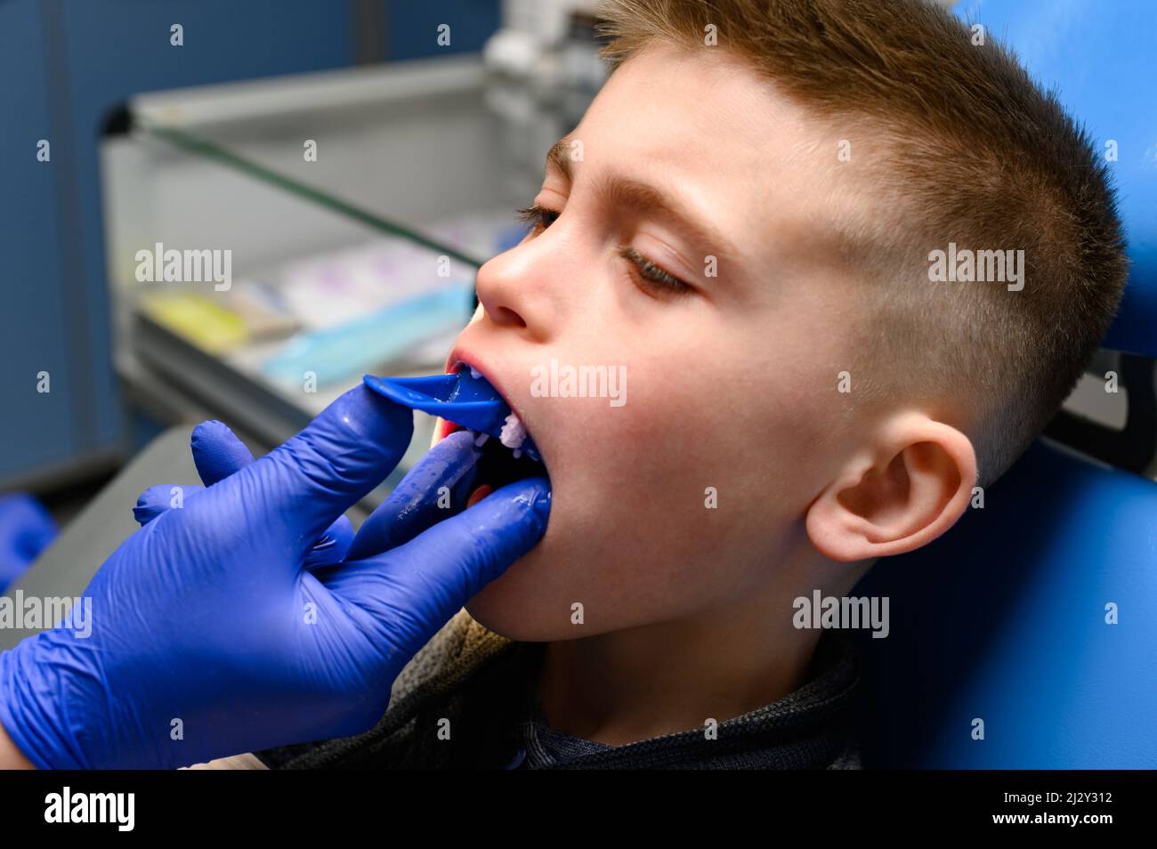 Jaw impression with a silicone diagnostic model, crooked teeth in a ...
