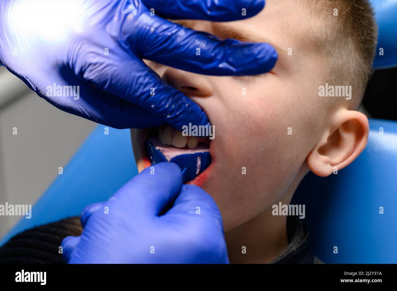 Jaw impression with a silicone diagnostic model, crooked teeth in a ...