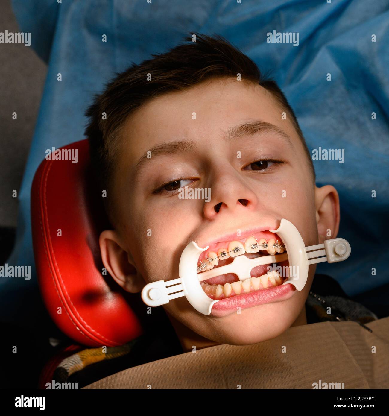 Visit to the orthodontist, installation of braces on the upper teeth ...