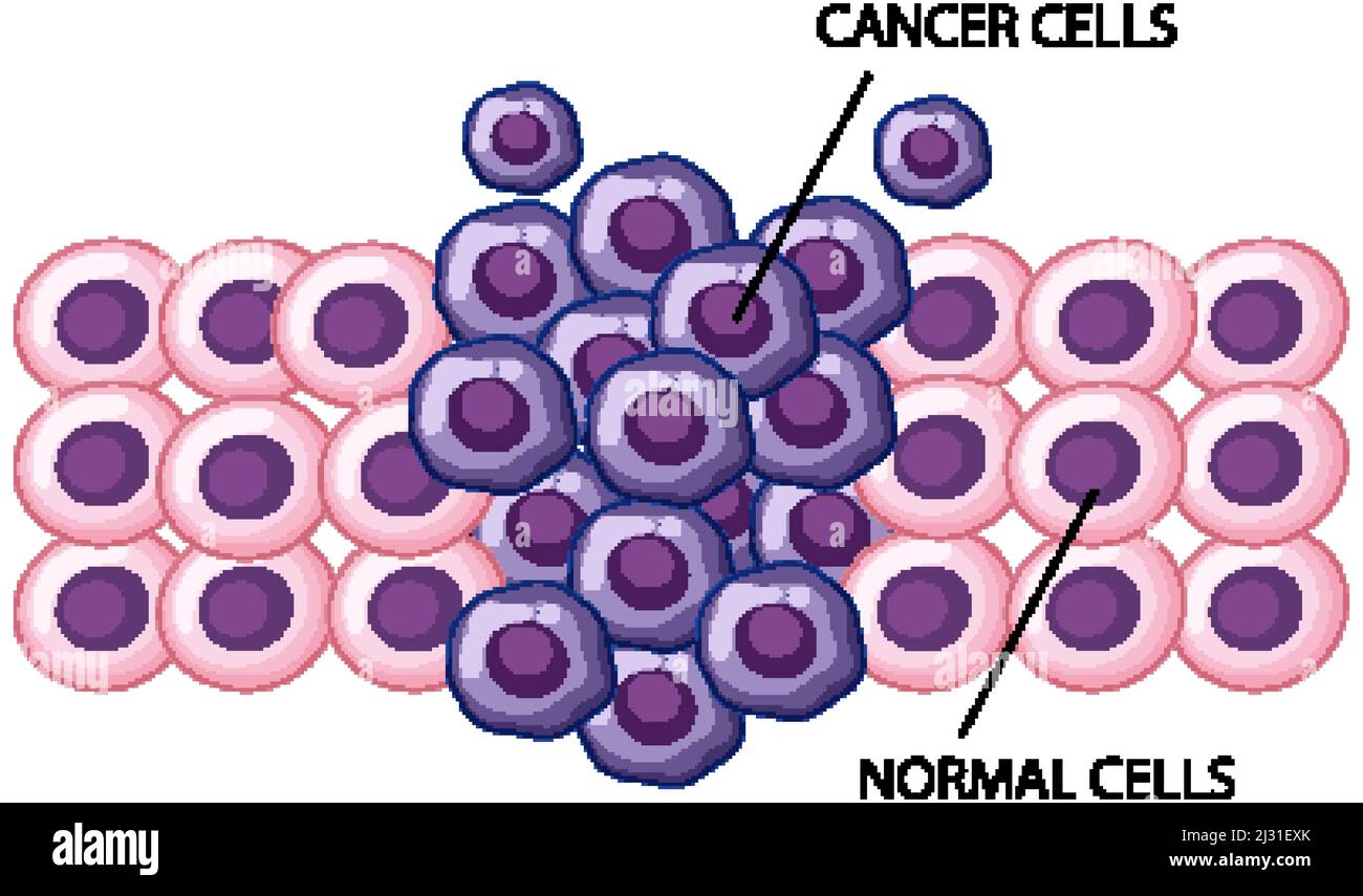 Process Of Cancer Cell Development Illustration Stock Vector Image And Art Alamy