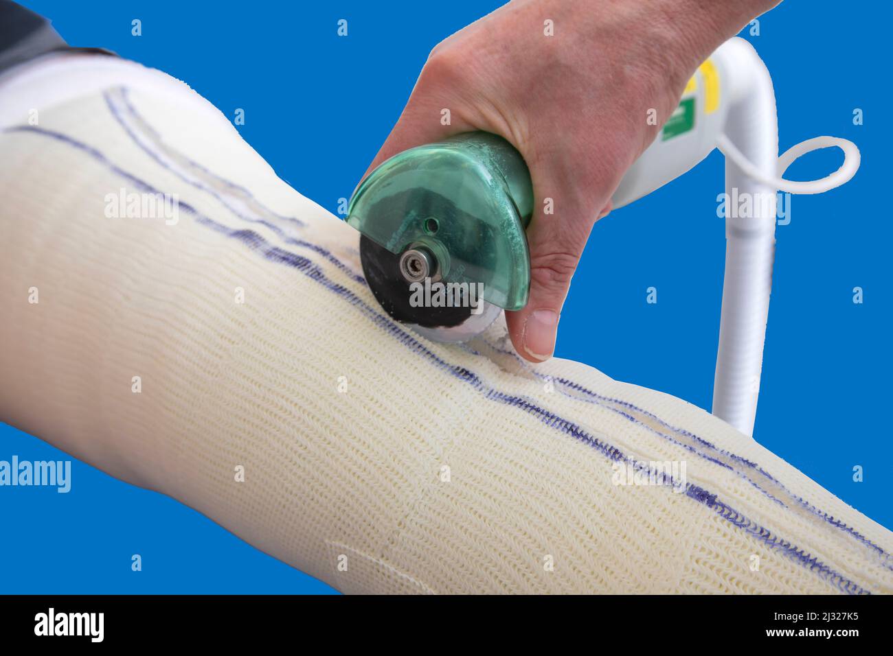 Netherlands, the orthopedic cast from plaster is removed from a leg ...