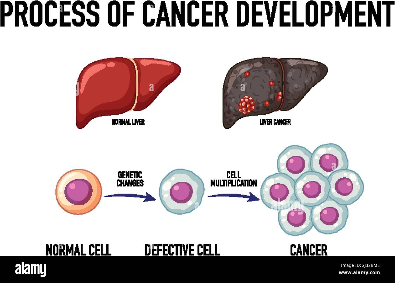 Diagram showing cancer development process illustration Stock Vector ...
