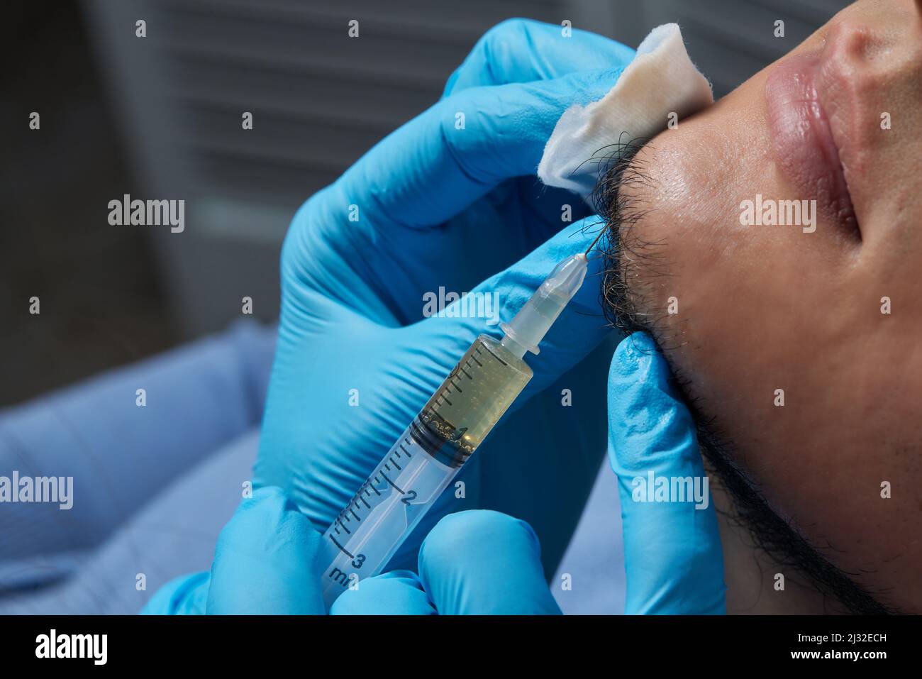 Injection plasma into beard hair man cosmetologist doctor Stock Photo ...