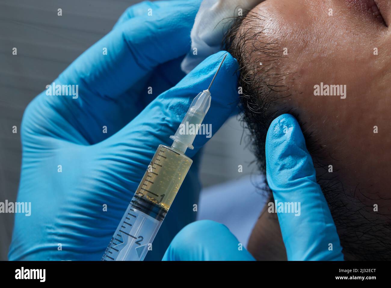 Injection plasma into beard hair man cosmetologist doctor Stock Photo ...