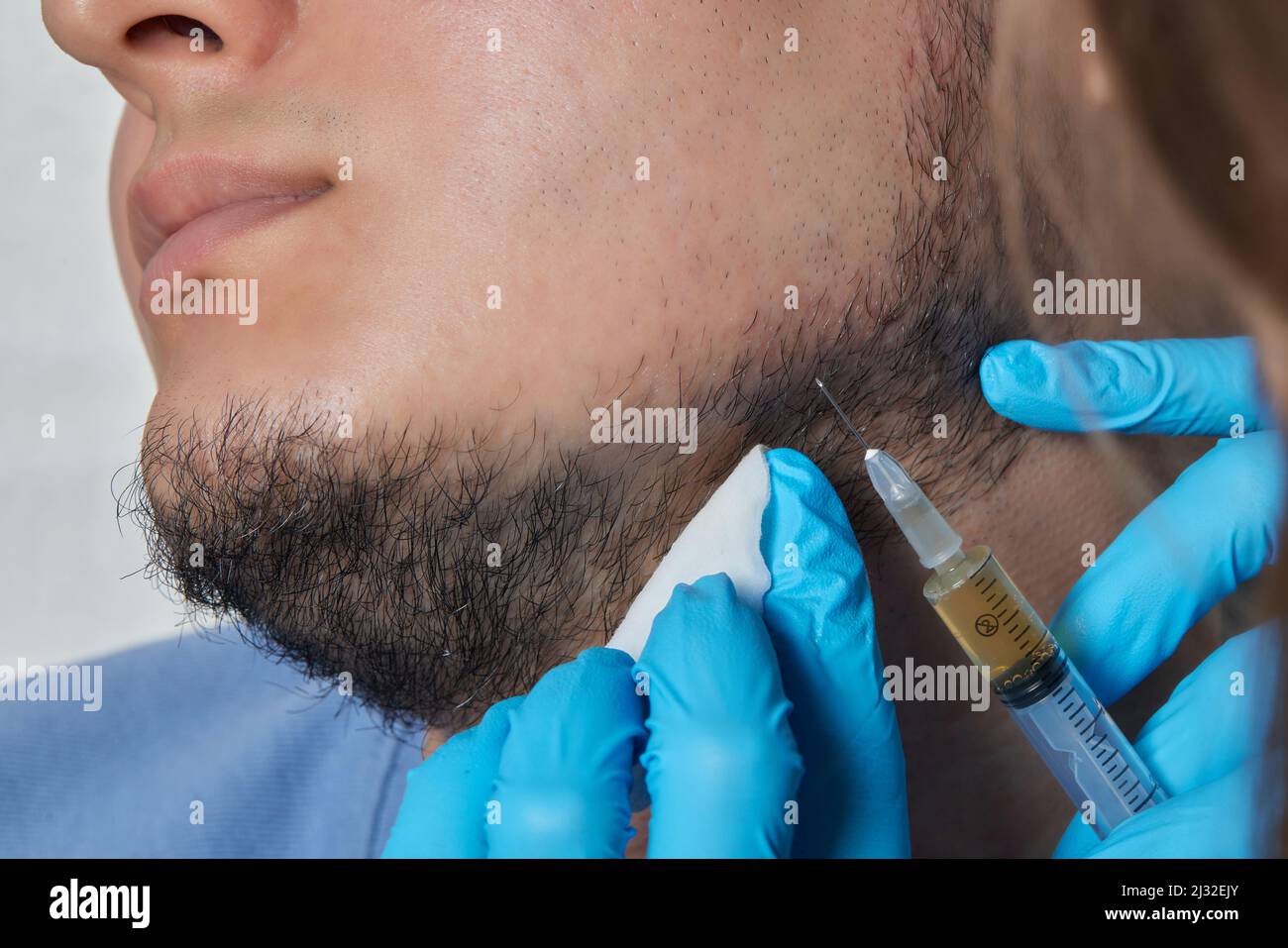 Injection plasma into beard hair man cosmetologist doctor Stock Photo ...