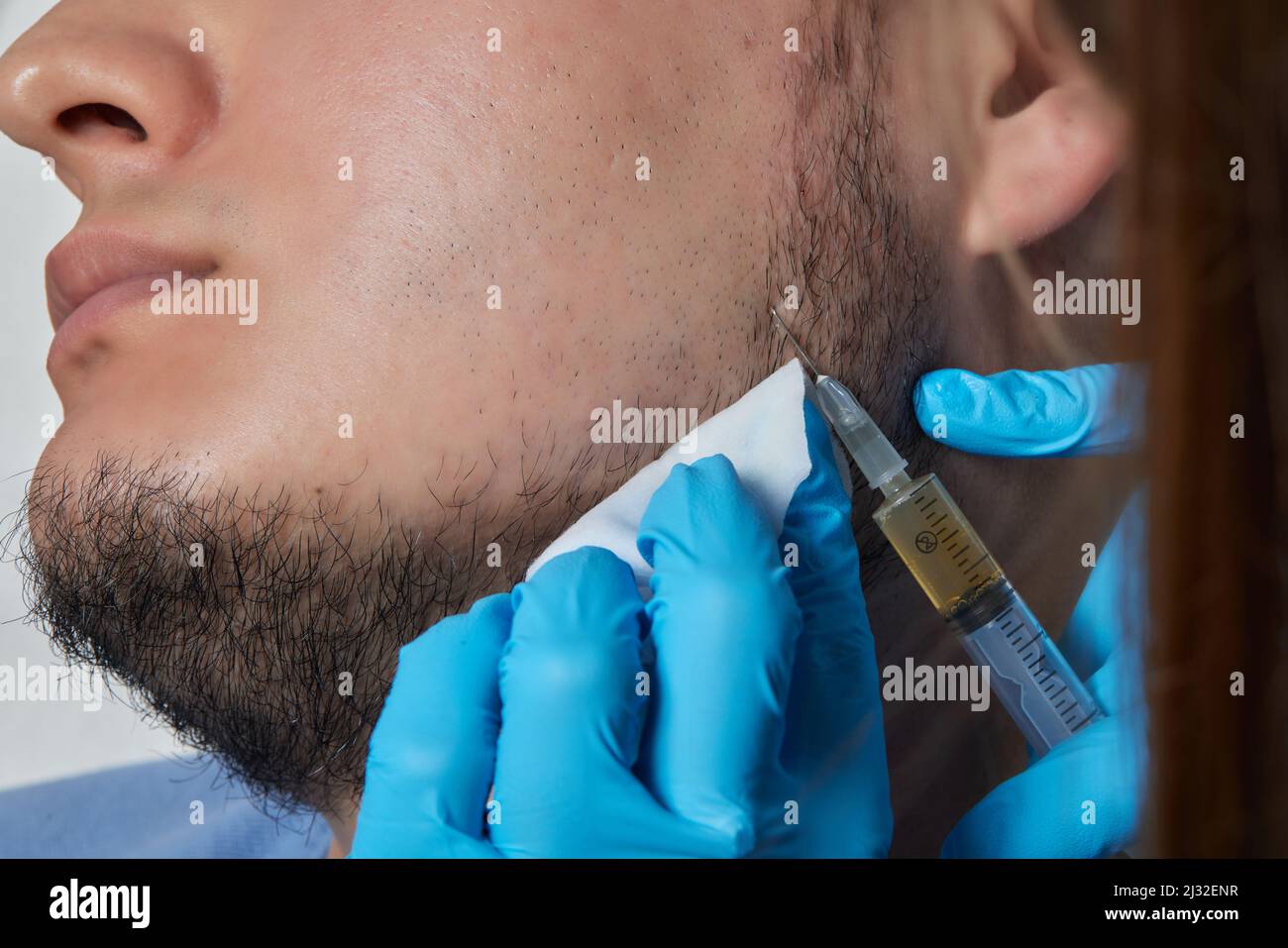 Injection plasma into beard hair man cosmetologist doctor Stock Photo ...